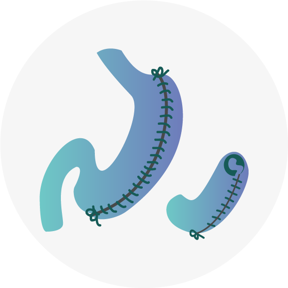 Gastric Plication - Dr. Hussam Al Trabulsi